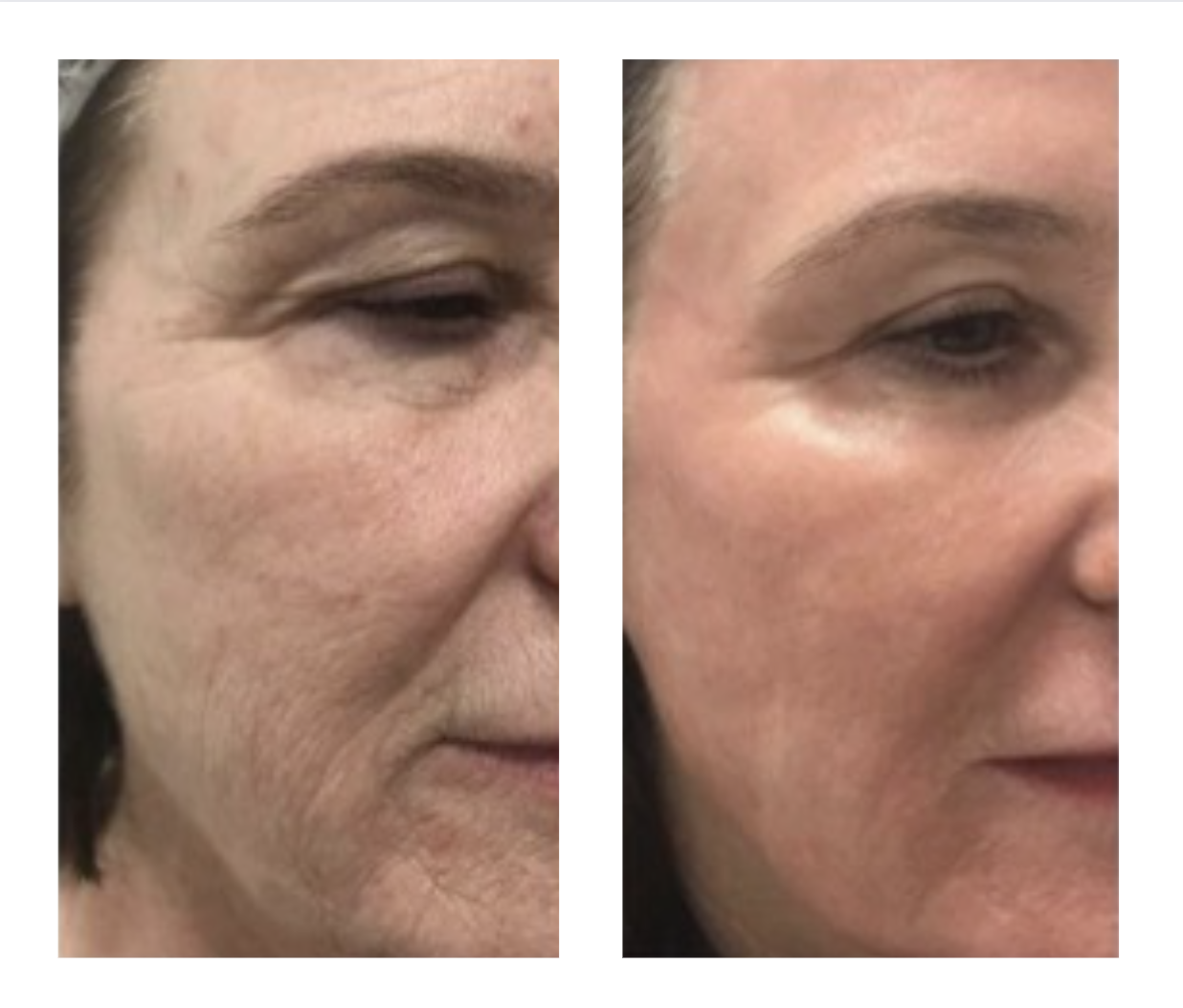 CO2 Fractional Laser - Oasis Wellbeing Clinic